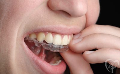 For Bite Guards – Lynchburg Family Dentistry
