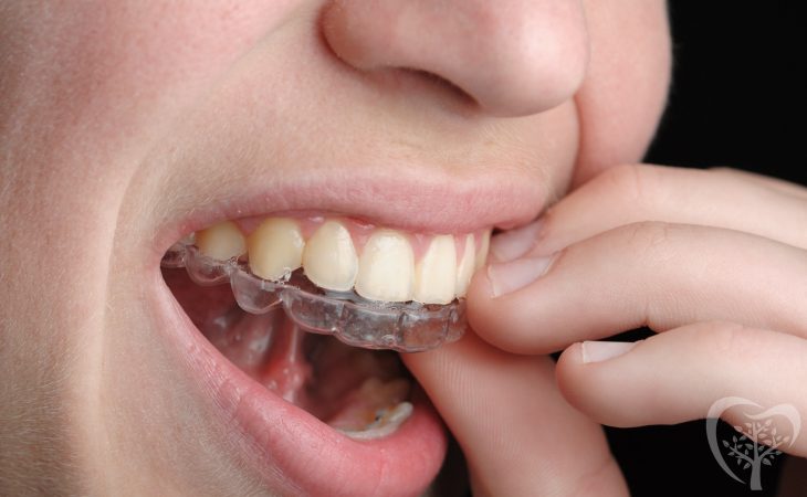 For Bite Guards – Lynchburg Family Dentistry